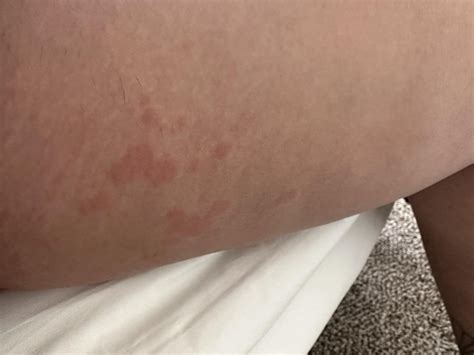 Rashes On Both Inner Thighs R Dermatology