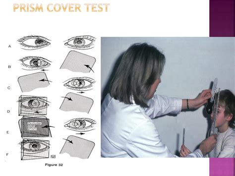 Ppt Strabismus Powerpoint Presentation Free Download Id 4244910