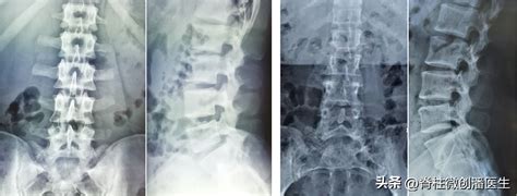 What Problems Will Lumbar Sacralization And Sacral Lumbarization Cause