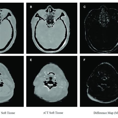The Comparison Of Ct And Synthetic Ct For Two Representative Mr Download Scientific Diagram