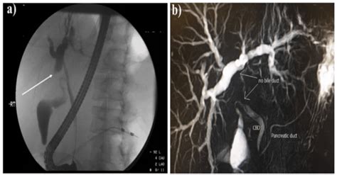 The Great Imposture Eosinophilic Cholangitis Surgical Case Reports