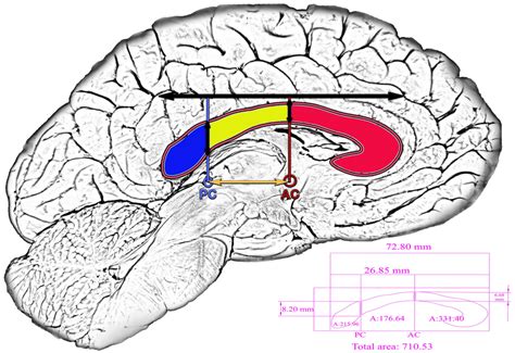 Colored Illustration Of The Corpus Callosum In A Midsagittal Section