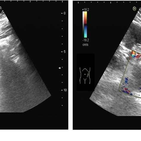 A Ultrasonic Image Mass In The Left Retroperitoneum With An