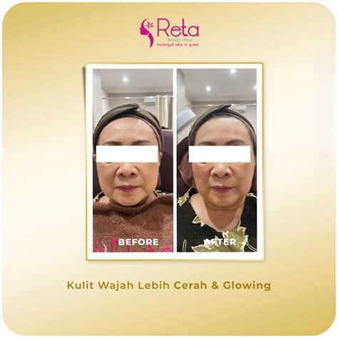 Before After Reta Beauty Clinic
