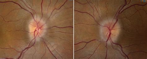 Papilledema
