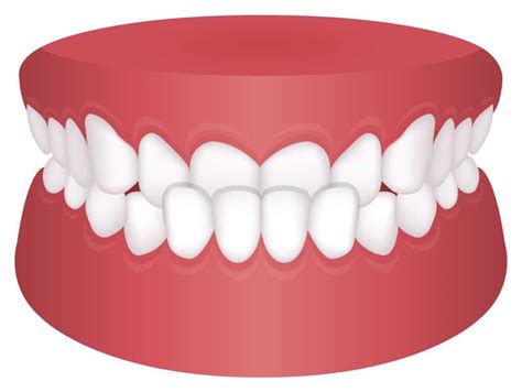 How To Fix An Underbite Wilkinson Dental