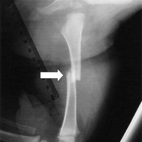 Comminuted Fracture Download Scientific Diagram