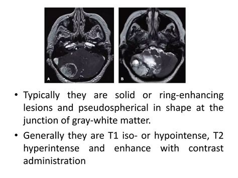 Palliation Brain Spinal And Bone Mets Pptx
