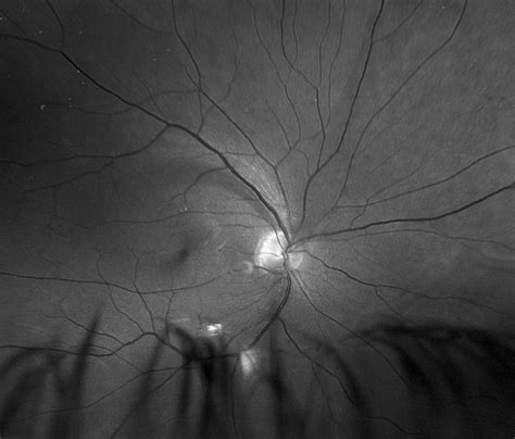 Sonoran Desert Eye Center Wedge Defect Reveals Nerve Fiber Loss