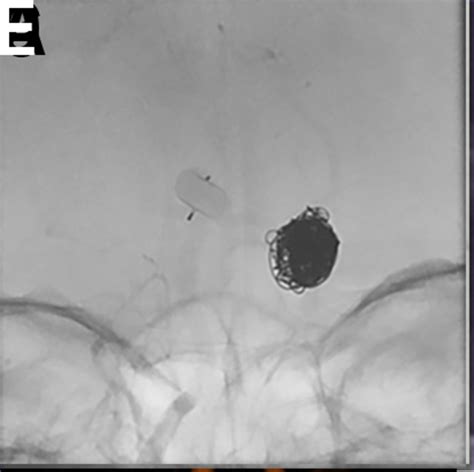 How To Web A Practical Review Of Methodology For The Use Of The Woven Endobridge Journal Of