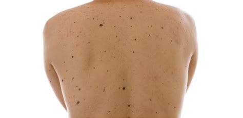 Surgical Excision Moles And Skin Tag Removal Luna Clinic