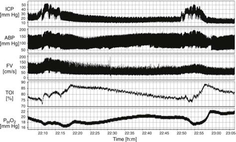 Multimodality Monitoring And Artificial Intelligence Neupsy Key