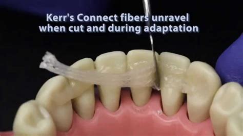 Ribbond Compared To Other Dental Fiber Reinforcement Materials Youtube