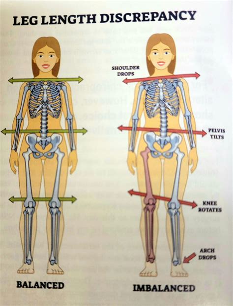 Dr Allen Avery Iii On Linkedin Functional Leg Length Inequalities Lli Occurs When The Legs Are