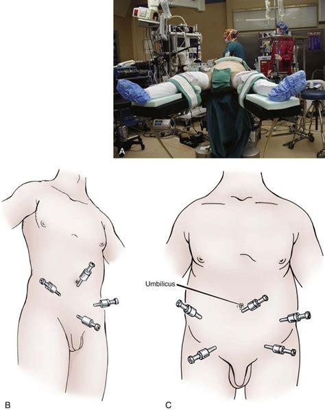 Surgery Of The Scrotum And Seminal Vesicles Abdominal Key