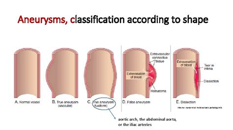 Aneurysms A Brief Discussion On Embolism Ali Al