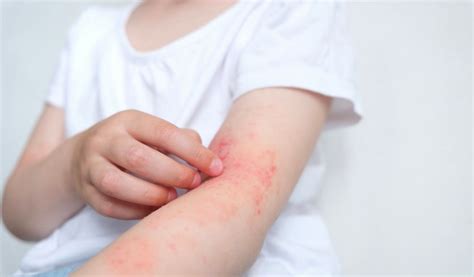 Impetigo O Que é Sintomas E Tratamento Blog Nav Dasa Impetigo O Que é Sintomas E Tratamento Blog Nav Dasa