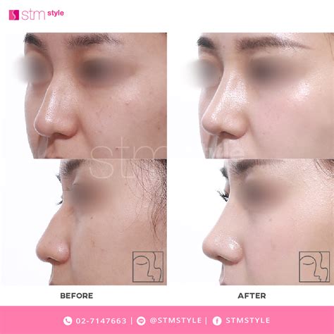 Nose Surgery Augmentation And Refinement Of The Nasal Tip Stm Style