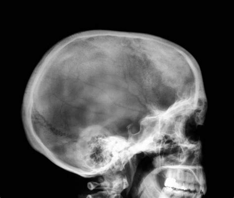 Mccune Albright Syndrome Causes Symptoms And Care