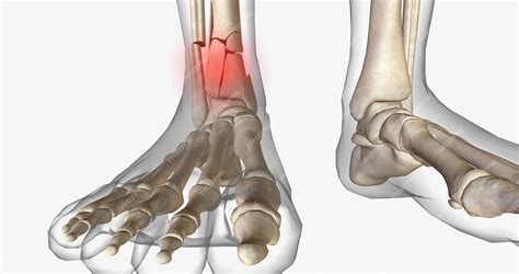Premium Photo Distal Tibia Fractures Affect The Ankle Joint And Can