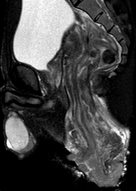 Rectosigmoid Carcinoma Presenting As Full Thickness Rectal Prolapse