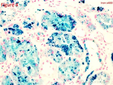 Hemosiderosis Teaching Point Arkana Laboratories