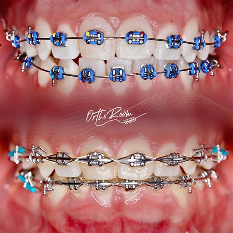 Ortho 🦷 ¡10 Meses De Evolución Con Ortodoncia Convencional 📸 Cada