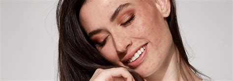 Periorale Dermatitis Behandlung Hamburg Elbklinik Hamburg