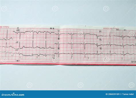 An Electrocardiograph Ecg A Chart That Draws The Electricity Of The