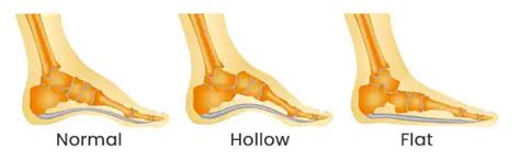 Foot Shape Differences In Morphology Podexpert