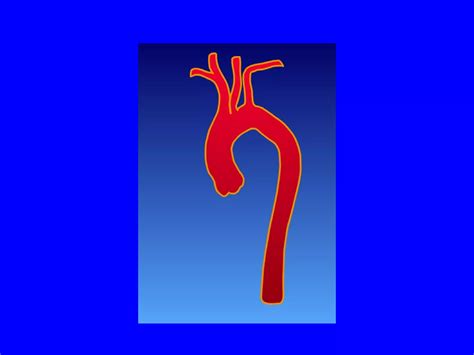 Aortic Ulcer Intramural Hematoma Aortic Dissection Ppt