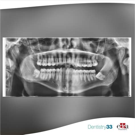 Limitations And Factors Influencing Molar Distalization Dentistry33