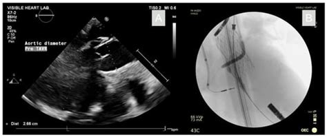 Multimodal Imaging Of A Chimney Stenting Procedure Performed