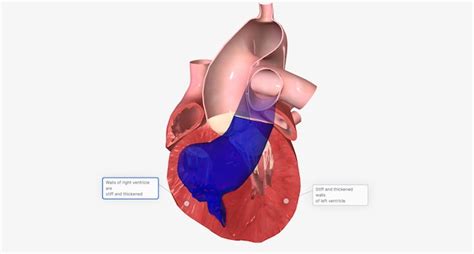 Premium Photo Congestive Heart Failure Rightsided Diastolic