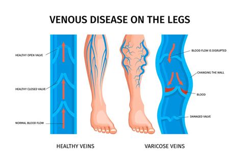 Understanding Varicose Veins Causes Symptoms And Advanced Treatments