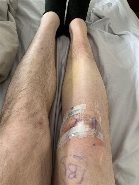8 Weeks Post Op Bear Acl Repair R Acl