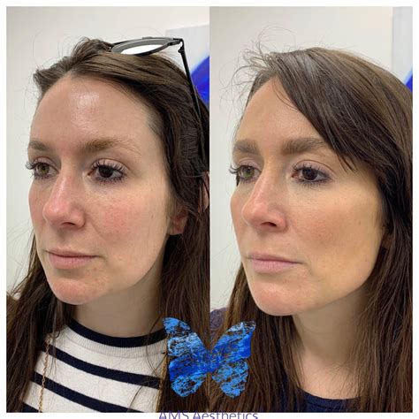 The Butterfly Effect Full Face Rejuvenation London Uk