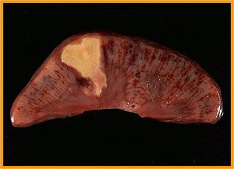 Ischemia And Infarction