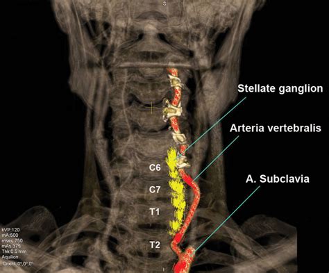 Complications Of Stellate Ganglion Block Sgb Anesthesia Key