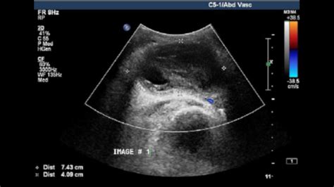 Pseudoaneurysm Internet Book Of Msk Ultrasound