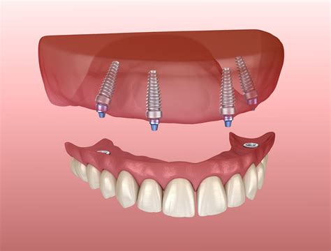 Implant Retained Denture 2 Denton Dental Center Blog