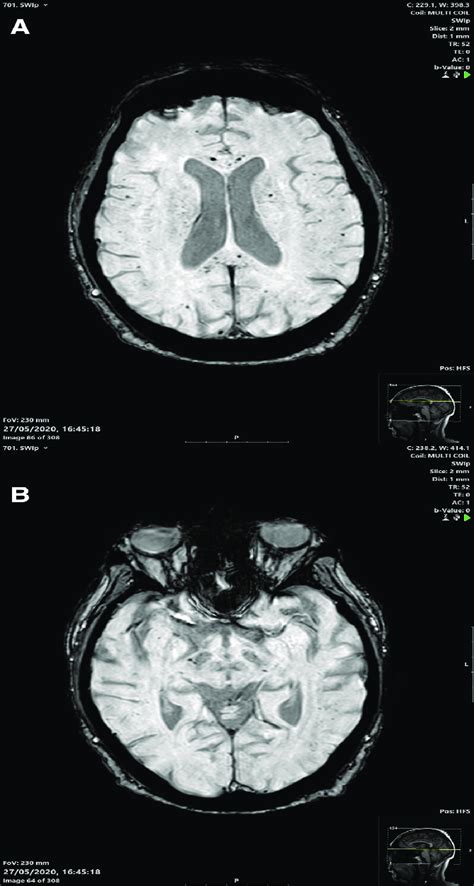 A Brain Mri Axial T2 Gradient Echo Scan At The Level Of The Body Of