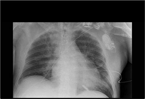 Is The New Micra Leadless Pacemaker Entirely Safe International