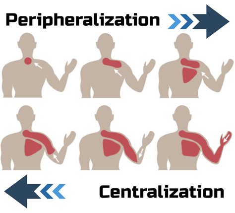 Centralization Peripheralization — Physiotherapy London Ontario