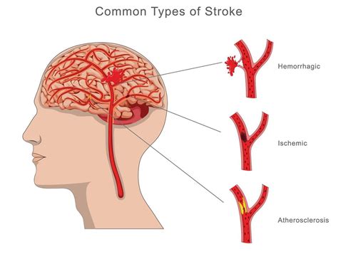 Illustration Of Common Types Of Brain Stroke Including Ischemic Hemorrhagic And Transient