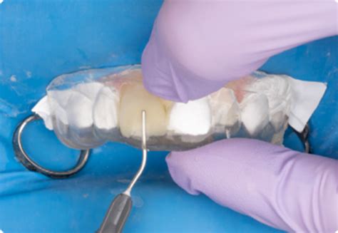 Injection Molding Technique Direct Restorative