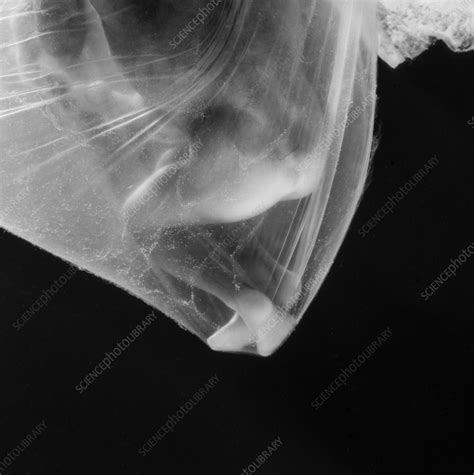 Human Foetus In Amniotic Sac At 5 Months Stock Image C0599243