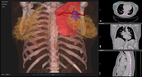 [video] Andrew Mcewen On Linkedin Fuckcancer Dicom 3d Vr