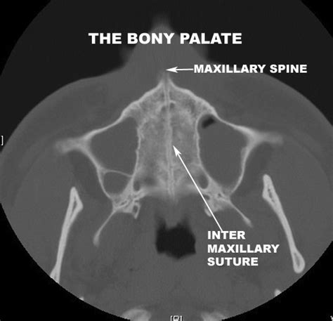 Identify The Intermaxillary Suture Click The Image For Labeling
