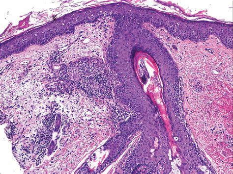 Extrafacial Rosacea With Predominant Scalp Involvement Indian Journal